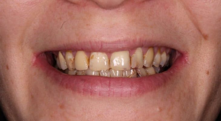 Fogszuvasodás és lyukas fog: fájdalommentes kezelés - Oriondental.hu